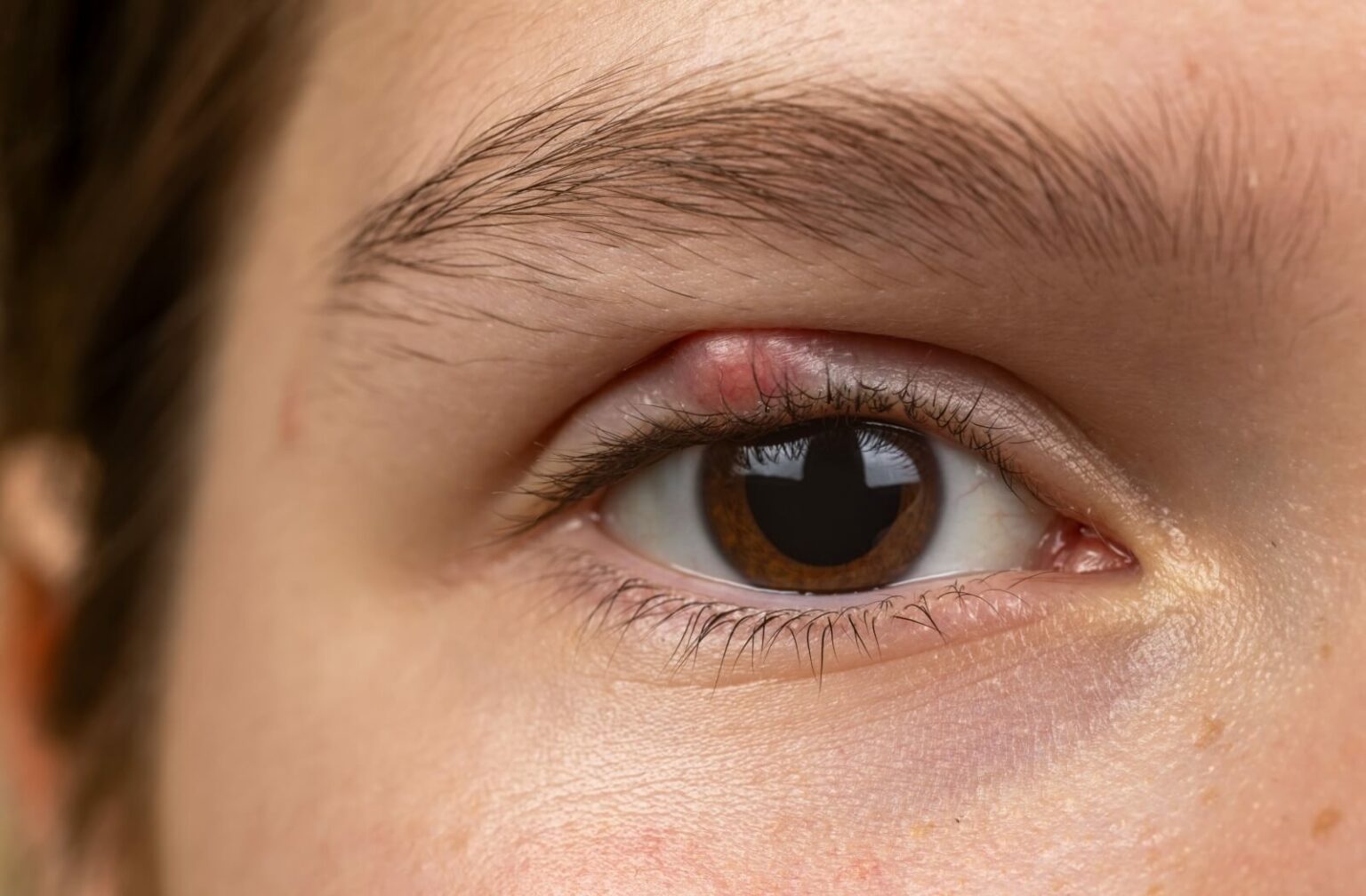 Pink Eye vs. Stye: How to Tell the Difference | Austin